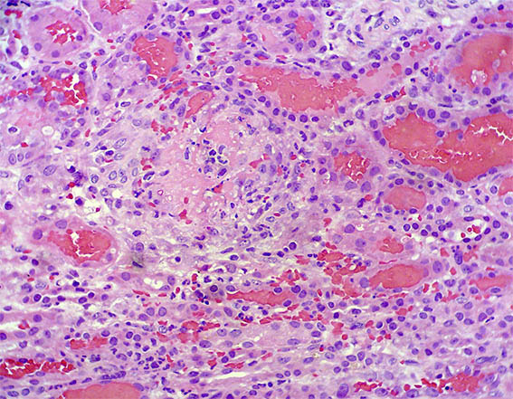 Acute_allograft_dysfunction