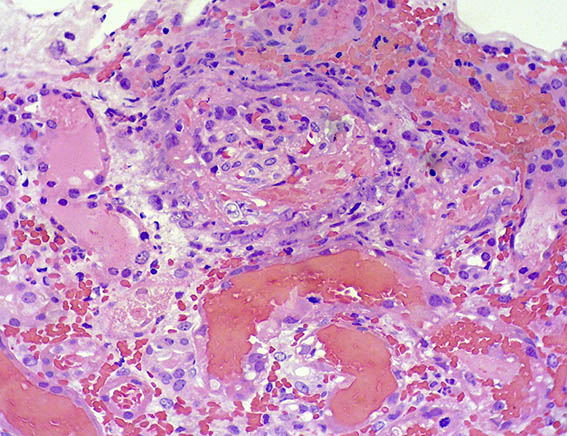 Acute_allograft_dysfunction