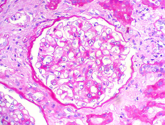 Mild proteinuria