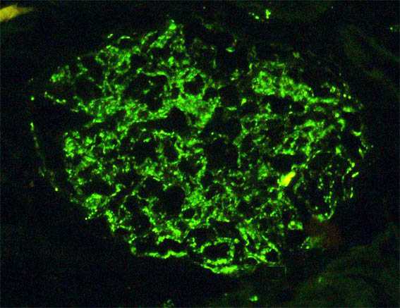 Sindrome nefritico y VIH