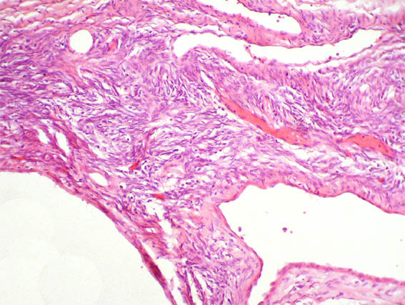 Multicystic renal mass