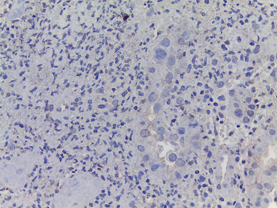 Graft kidney dysfunction