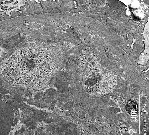 Diarrhea Anemia and AKI in a Girl
