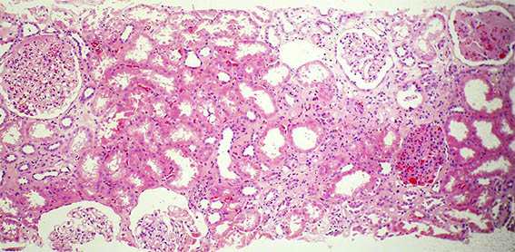 Case renal pathology
