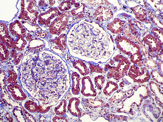 Case renal pathology