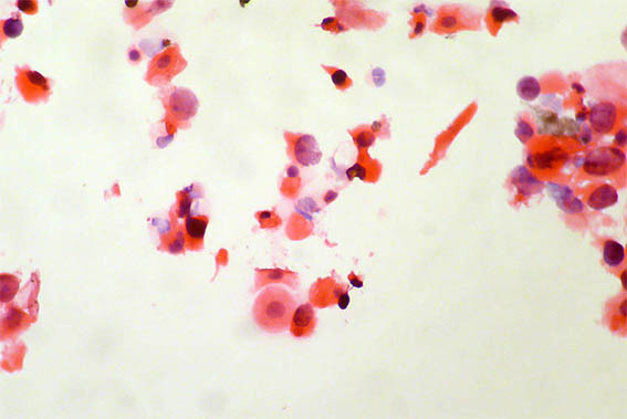 Cellular Casts with Inclusions - Urine