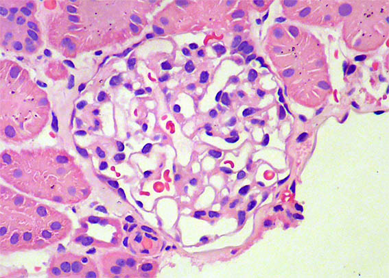 Pediatric Nephrotic Syndrome