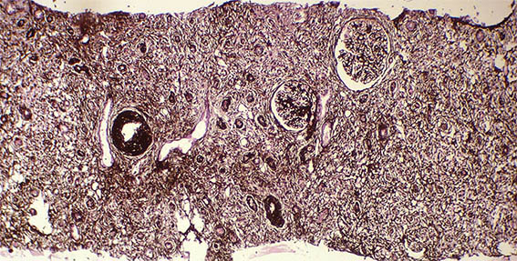 Enfermedad renal progresiva