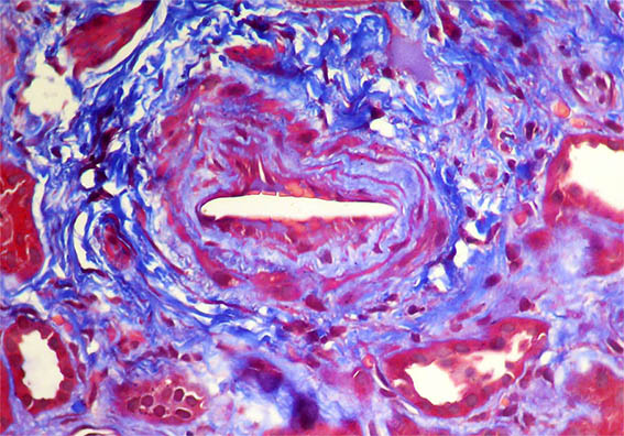 LRA Post Correccion Aneurisma Aorta