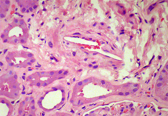 LRA Post Correccion Aneurisma Aorta