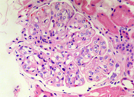 Nephritic Syndrome and Vasculitis