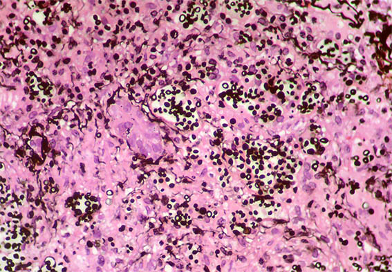 Acute Kidney Injury and HIV