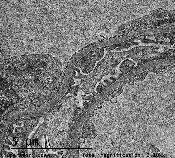 Sjögren and Kidney Disease