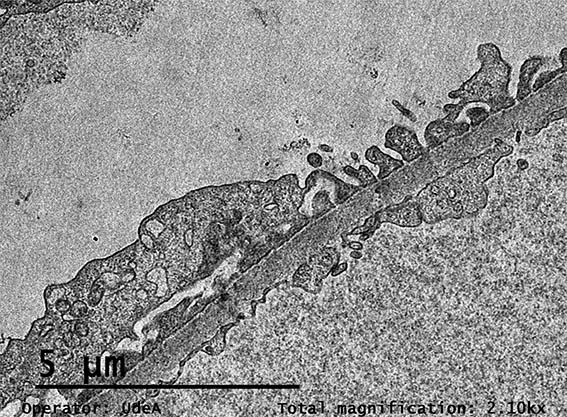 Sjögren and Kidney Disease