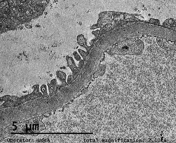 Sjögren and Kidney Disease