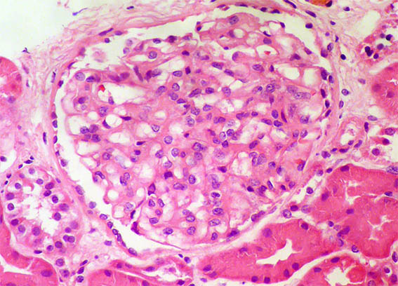 Recurrence of Nephrotic Syndrome