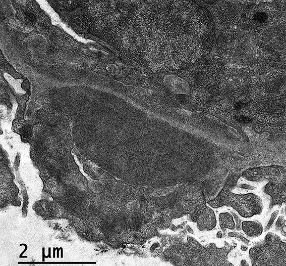 Post-transplantation Glomerulopathy