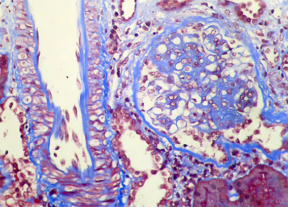 Post-transplantation Glomerulopathy