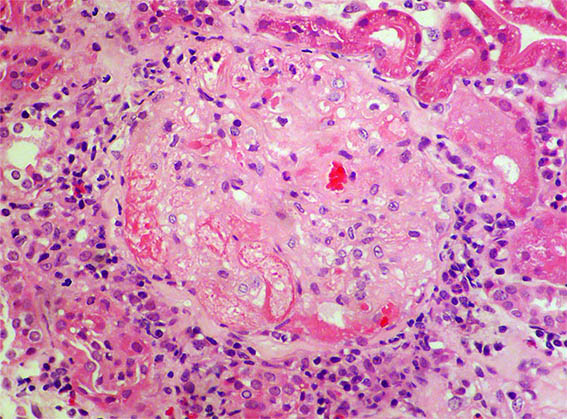 Acute rejection and TMA