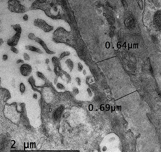 Nodular Glomerulosclerosis