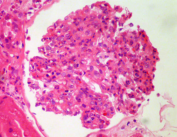 Nephritic Syndrome in Adult