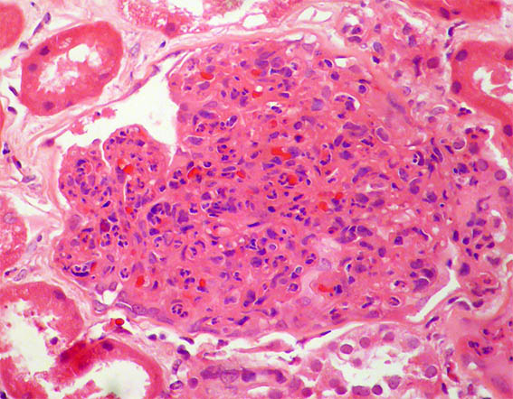 Nephritic Syndrome in Adult