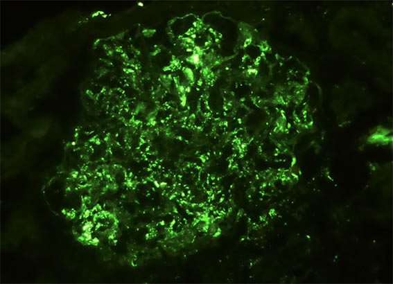 Adulto con Sindrome Nefritico