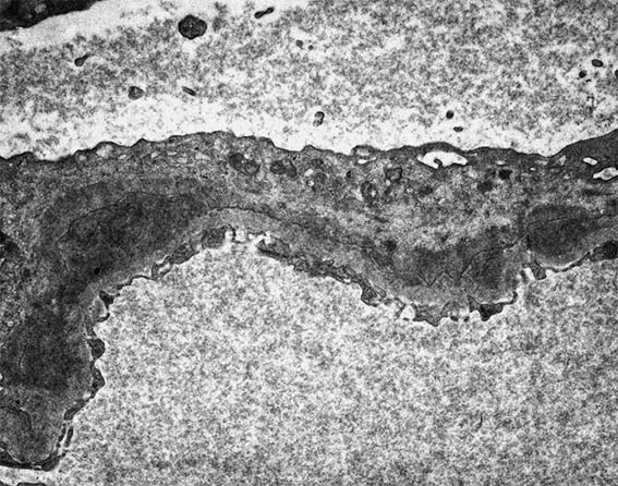 Nephritic Syndrome in Adult