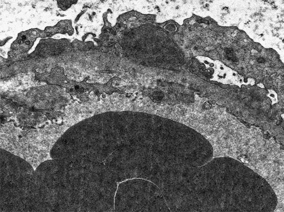 Nephritic Syndrome in Adult